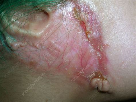 Pyoderma Gangrenosum Treated With Infliximab Stock Image C056 2647 Science Photo Library