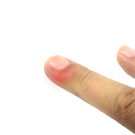 Phlegmon Causes Symptoms Diagnosis Treatment And Prevention