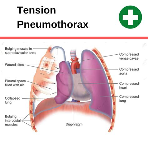 Can Cpr Cause A Pneumothorax Collapsed Lung Cpr Test