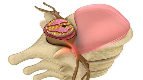 坐骨神经痛的症状和治疗方法 疾病科普 博禾医生