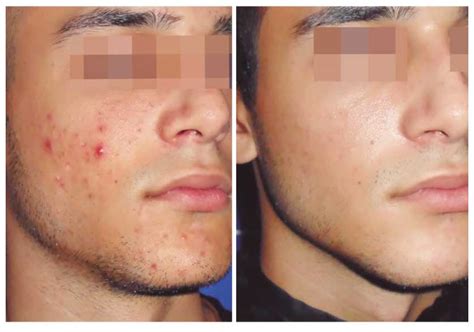 Scars And Acne Scars Skinrx Aesthetic Clinic Pty Ltd