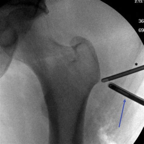This Fluoroscopic Anteroposterior Image Of A Left Hip Shows The Download Scientific Diagram