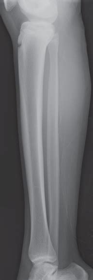 Female Tibia And Fibula Radiology Key