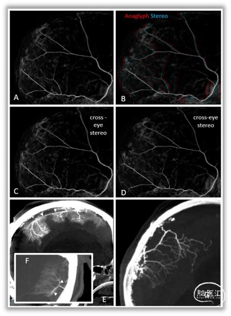 硬脑膜血管解剖在慢性硬膜下血肿栓塞治疗中的意义 脑医汇
