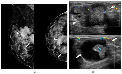 A 46 Year Old Woman Presented With Palpable Masses In The Breast