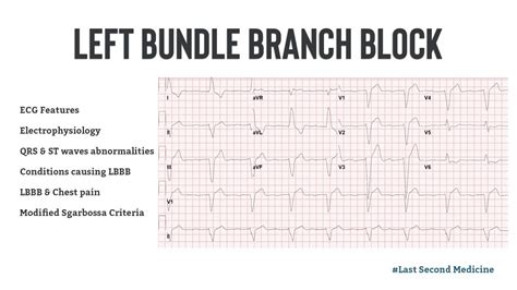 Left Bundle Branch Block Ecg Features Electrophysiology Causes And Differential Diagnosis