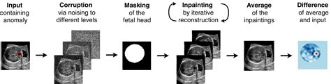 Unsupervised Detection Of Fetal Brain Anomalies Using Denoising