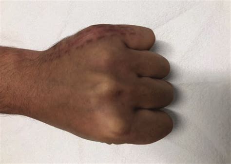 Patient Exhibiting Up To 80 Degree Flexion At The Mcp Joint Download
