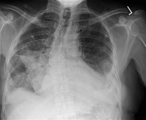 Patient With Acute Shortness Of Breath Elevated D Dimer And A Previous History Of Cancer