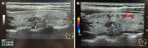 Figure 1 From Intra Thyroid Esophageal Duplication Cyst A Case Report Semantic Scholar