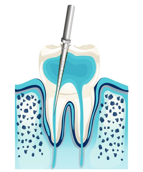 Root Canal Treatment In Sri Ganganagar Integra Medical And Dental Center