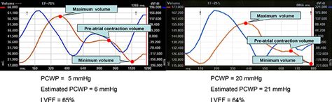 Noninvasive Measurement Of Pulmonary Capillary Wedge Pressure By