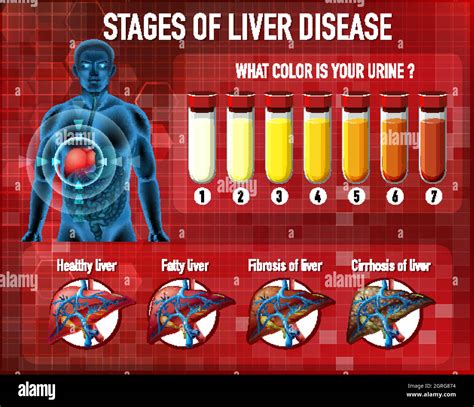 Stages Of Liver Disease Stock Vector Image And Art Alamy