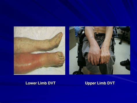 Ppt Incidence Powerpoint Presentation Free Download Id 157921