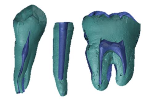 Segmenting The Root Canal Space Of The Tooth Support 3d Slicer Community