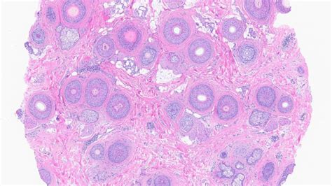 Dermatopathology Fellowship Columbia University Department Of Dermatology