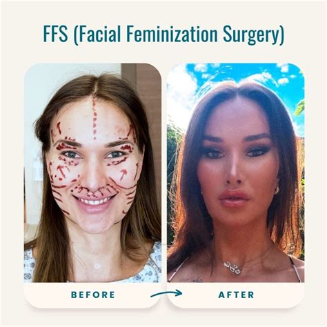 Facial Feminization Surgery Precision That Respects Identity Imed