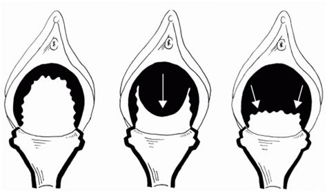 Anterior Wall Support Defects Abdominal Key