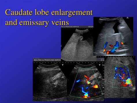 Ultrasound In Portal Hypertension