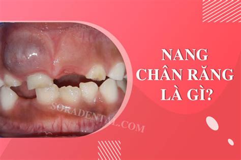 Nang Chân Răng Là Gì Cách điều Trị Nang Chân Răng Soradental