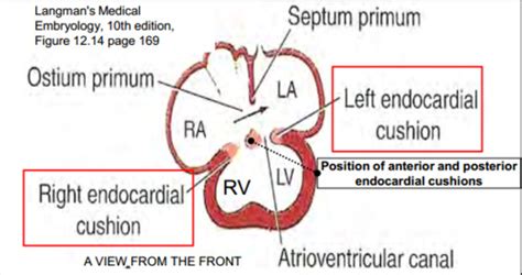 Endocardial Cushion Defect