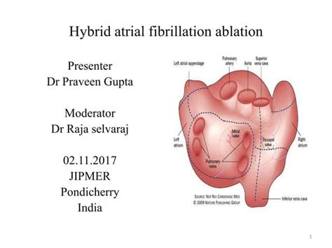 Hybrid Atrial Fibrillation Ablation Pptx Heart And Cardiovascular
