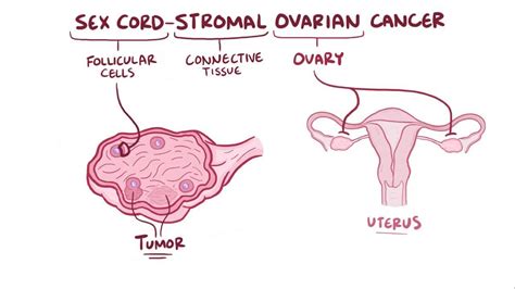 Video Sex Cord Gonadal Stromal Tumor