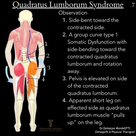 Quadratus Lumborum Straincausessymptomstreatment Thieme Atlas Der