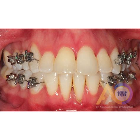 Management Of Vertical Maxillary Excess With ‘surgery Only Approach — Dr Aslam Alkadhimi