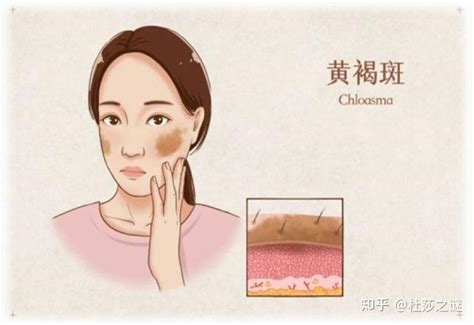 黄褐斑不一般 知乎
