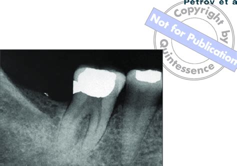 A Hamp Degree Ii Furcation With Enough Interproximal Bone Height To Download Scientific Diagram