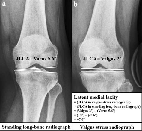 Preoperative Latent Medial Laxity And Correction Angle Are Crucial