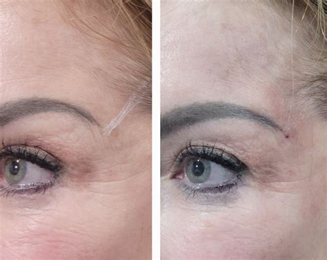 V Soft Lift Pdo Threads Eagle River Aesthetics