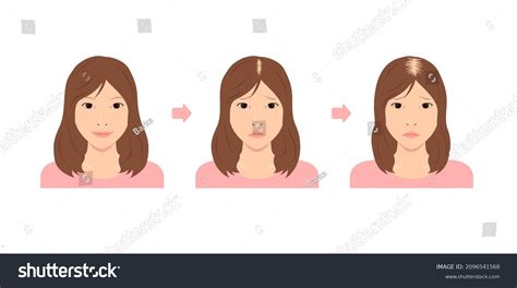 Progress Female Androgenetic Alopecia Vector Illustration Stock Vector Royalty Free 2096541568