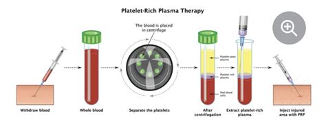 PRP Scalp Skin Orchid Aesthetic Beauty Clinic