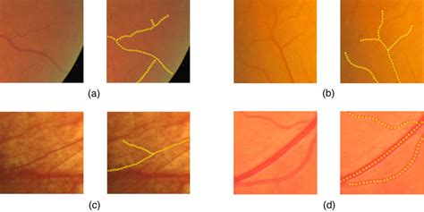 Sample Vessel Tracking And Bifurcations Detection In Retinal Images