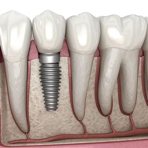 Implant Crown Crowns And Implant Dentistry