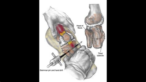 Tibial Skeletal Traction Pin Placement Youtube