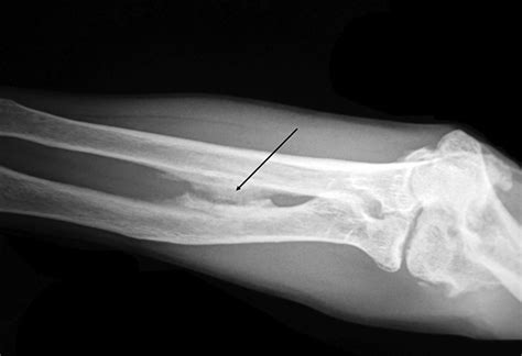 A Unique Cause Of Interosseous Membrane Calcification Bmj Case Reports
