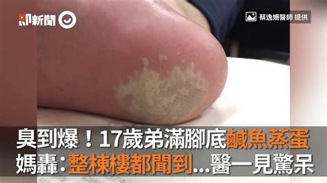 臭腳宛如鹹魚蒸蛋 原來是皮膚病 足蹠蠹蝕症 凹陷狀角質溶解症 YouTube
