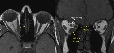 Thyroid Eye Disease Radiology At St Vincents University Hospital