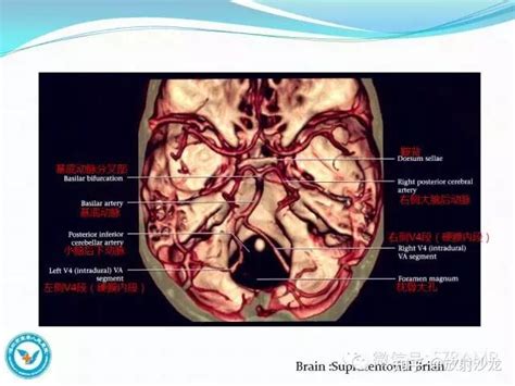 椎 基底动脉系统ct，mr及dsa影像解剖 知乎