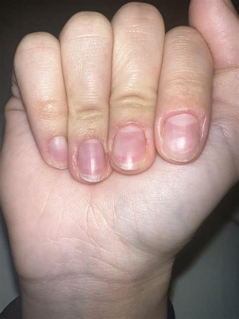 Is This Early Stages Of Onycholysis Rdermatology