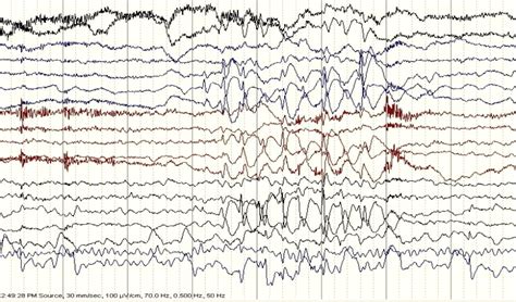 Eeg Signal Of Patient During Epilepsy Download Scientific Diagram
