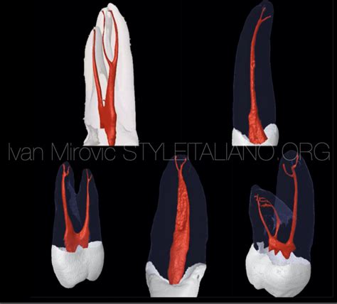 deep split management tips and tricks style italiano endodontics