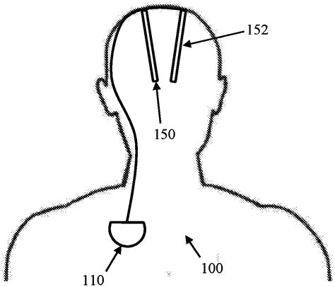 Brain Neurostimulator Electrode Fitting Eureka Patsnap