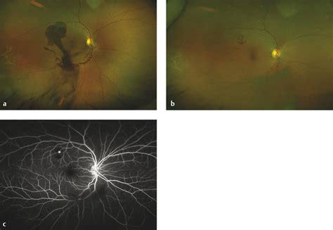 Retinal Arterial Macroaneurysm Ento Key