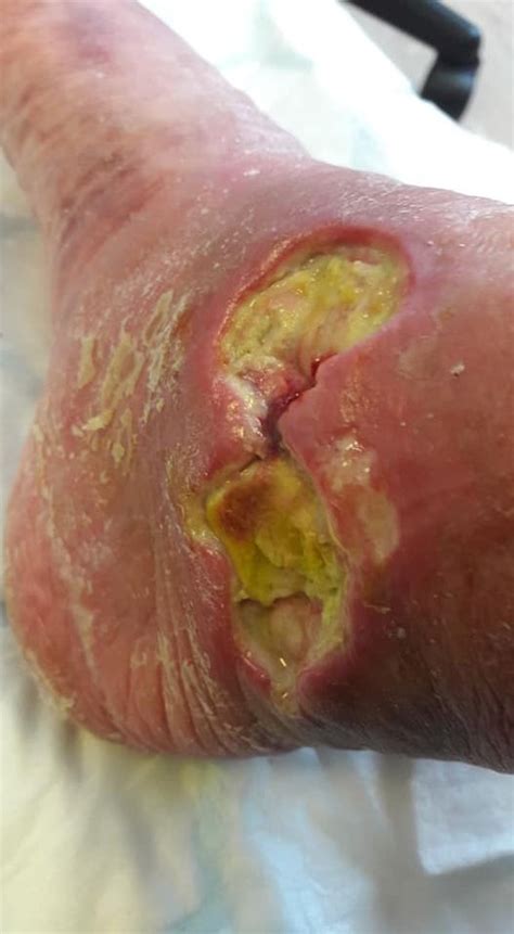 Ankle Update Acute Cellulitis 6wks 2 Days Doppler Scan Scheduled Scrolller