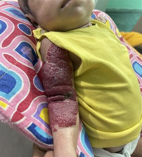 Excellent Recovery In A Case Of Hemangioma Homeo Energy