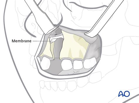 Alveolar Bone Grafting For Unilateral Cleft Lip Andor Palate